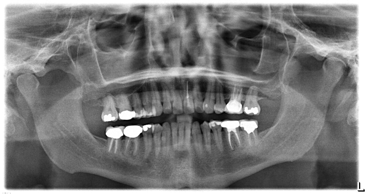 Digital X-rays and Imaging - John R. Lindeman, DDS | General and ...